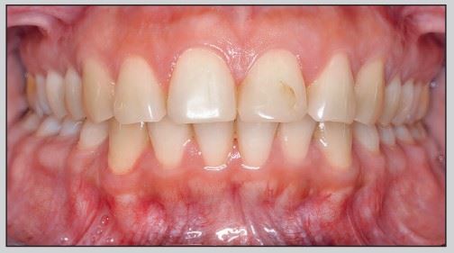Posterior Bite Collapse and Diagnostic Grading for Periodontitis